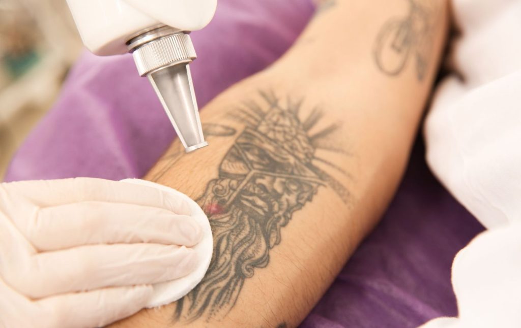 Tatuajes: las alternativas más eficaces para quitártelos | Pag: 2 Tatuajes: las alternativas más eficaces para quitártelos | Pag: 2
